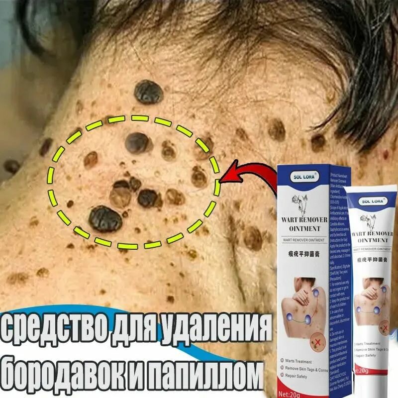 Крем гель от папиллом, чистотел, средство от бородавок. Натуральные растительные ингредиенты,20 гм