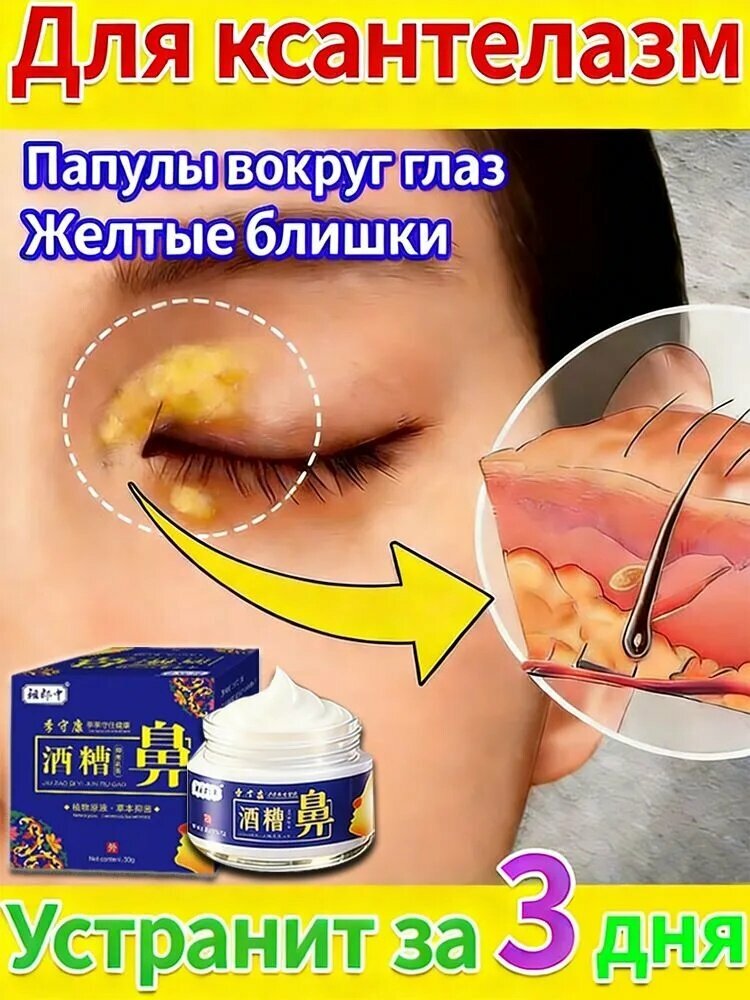 Мазь от ксантелазмы и ксантом на веках и лице. Лечение папул и желтых бляшек вокруг глаз. Эффективное средство против атеромы