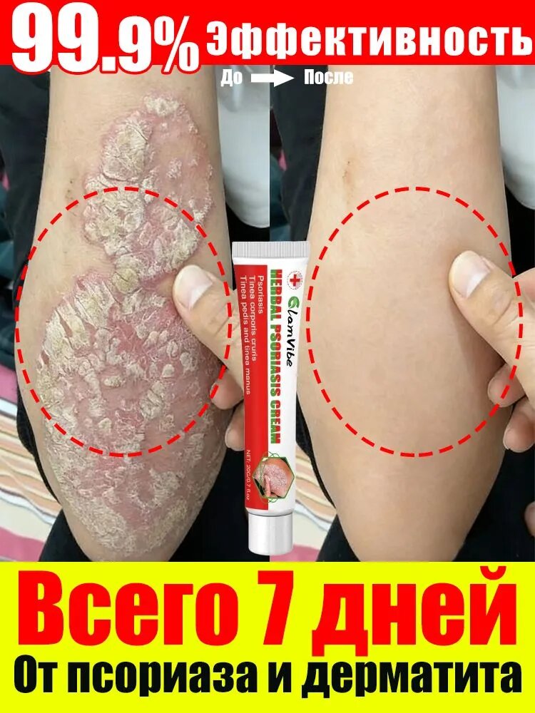 Крем от псориаза Быстрое облегчение зуда, лечение экземы, невропатического дерматита, грибковых заболеваний, дерматита и себореи эффективный уход за кожей,20г