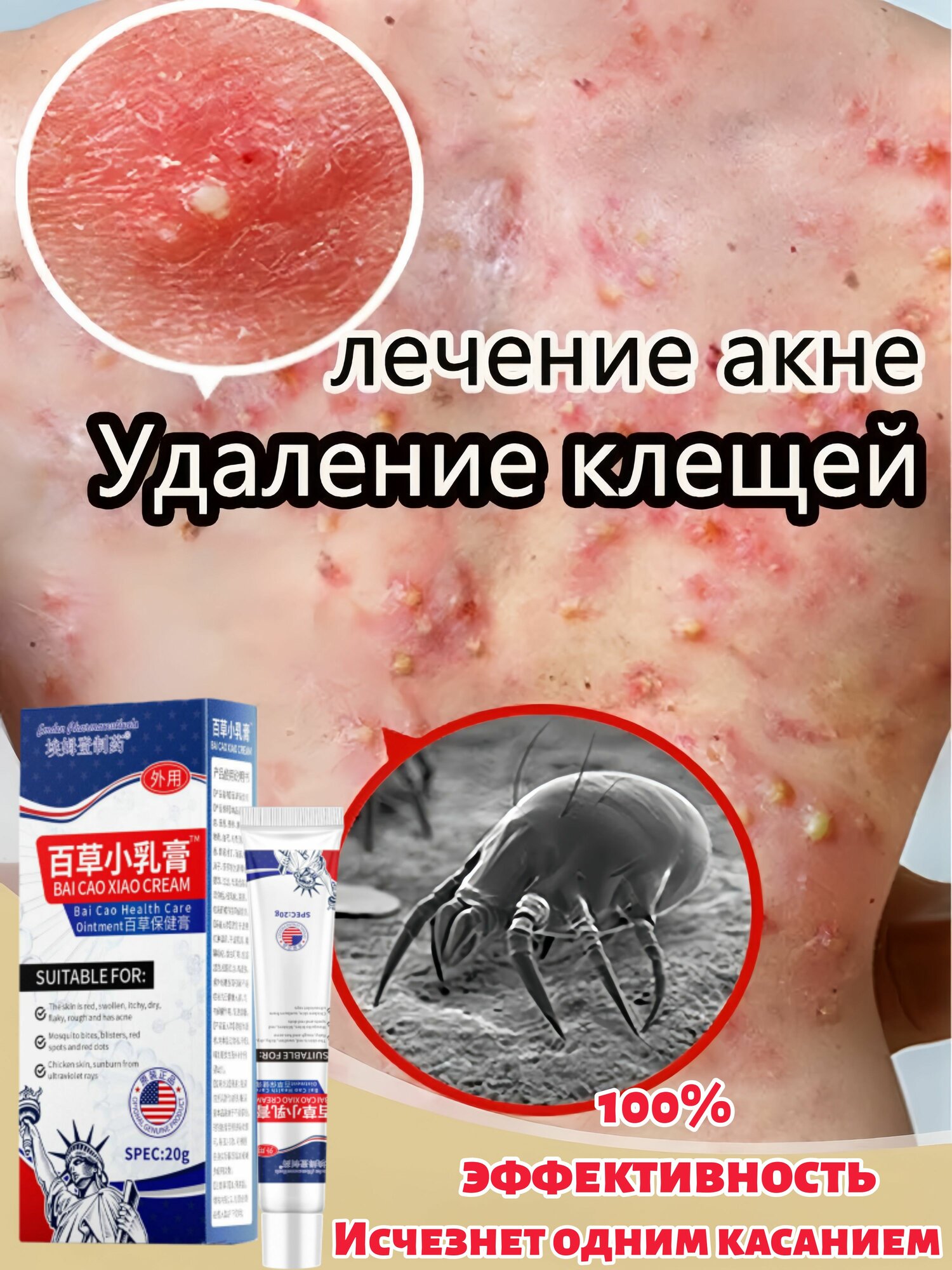 Мазь от угревой сыпи применяется при дерматитах и экземах на теле и спине, антибактериальная, против клещей и зуда, 20 мл