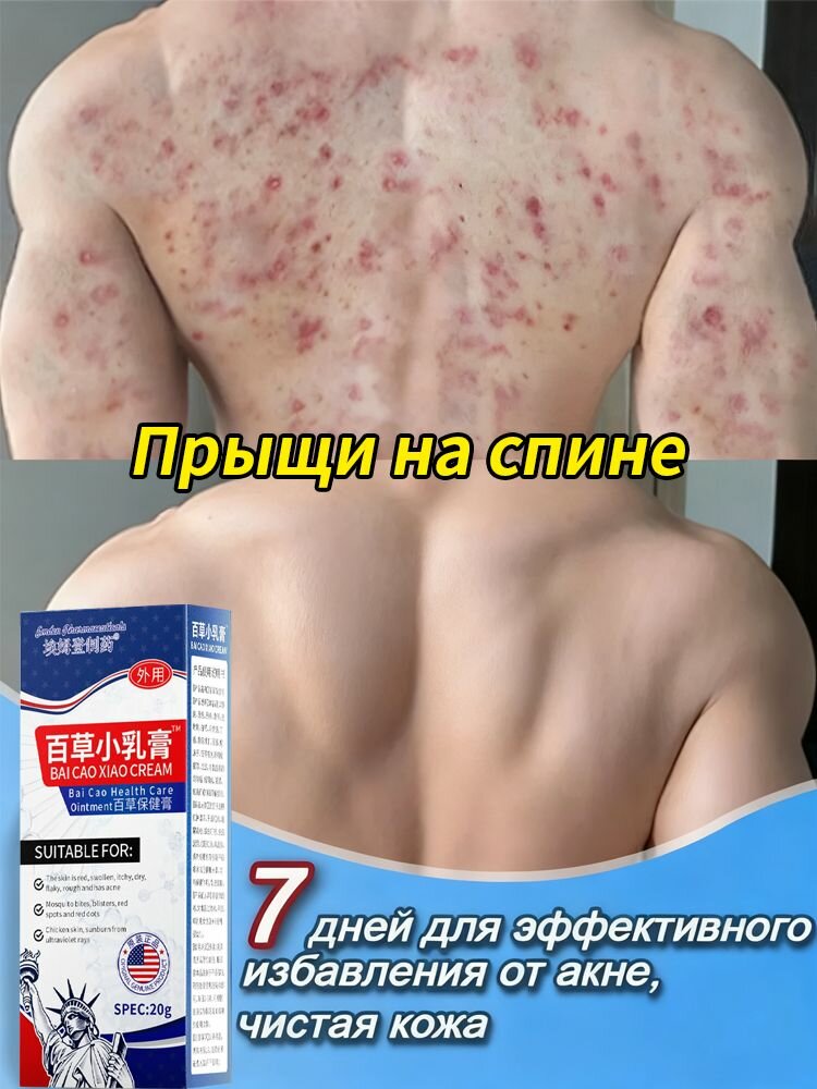 Мазь от угревой сыпи/Мазь фолликулита на спине, используется для лечения угревой сыпи и воспалительных высыпаний, для ухода за кожей, 20 мл