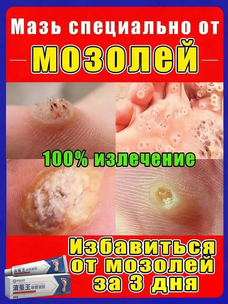 Эффективный крем для быстрого избавления бородавок, мозольный удаления мозолей, натоптышей, средство от шипиц на ногах, китайская чудо мазь 20 г от мазолей и надоптвшей, колломак от бородавок