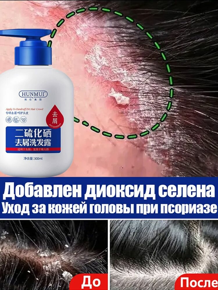 Сильный шампунь от перхоти, для лечения перхоти, псориаза и себорейного дерматита, 300 мл