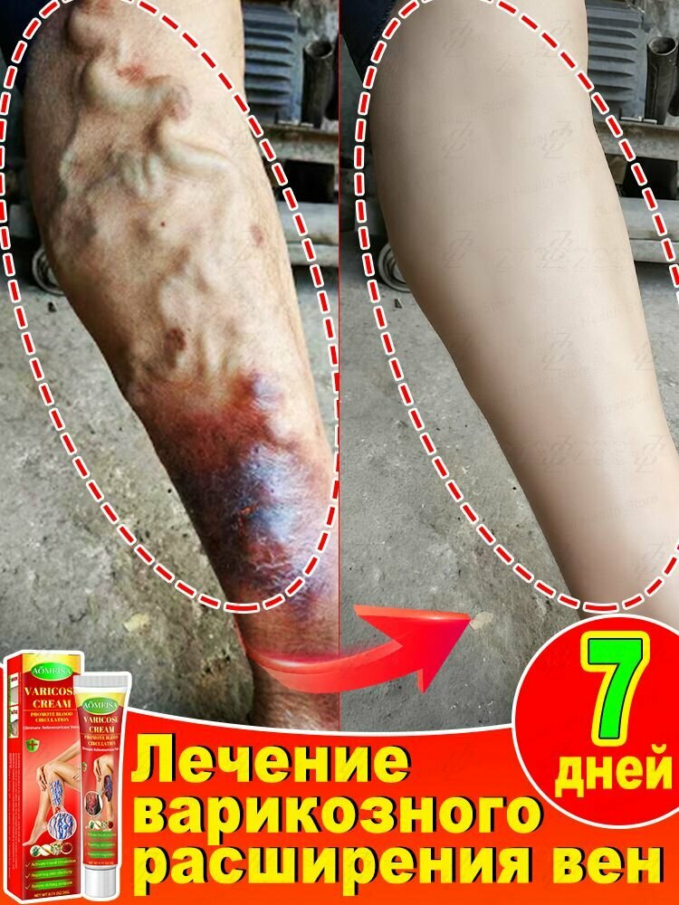 Мазь от варикоза для ног - снимает отеки, укрепляет сосуды, улучшает кровообращение