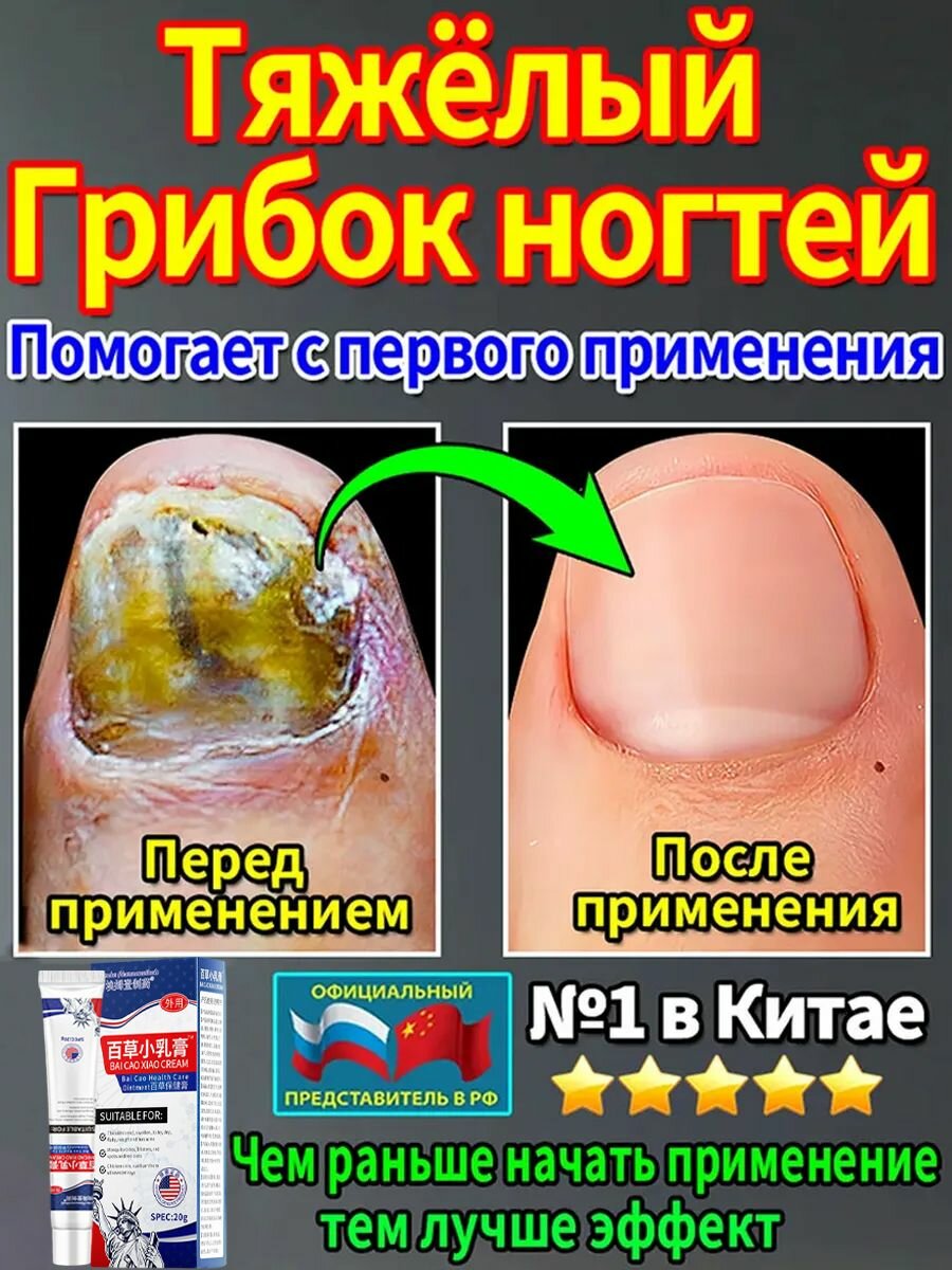 Мазь ноготок от грибка ногтей на ногах, Лечите грибковые инфекции, укрепляйте и восстанавливайте ногти и роговой слой кожи, а также устраняйте грибок ногтей на ногах. противогрибковая мазь для ног лечение грибка стопы укрепление ногтей восст