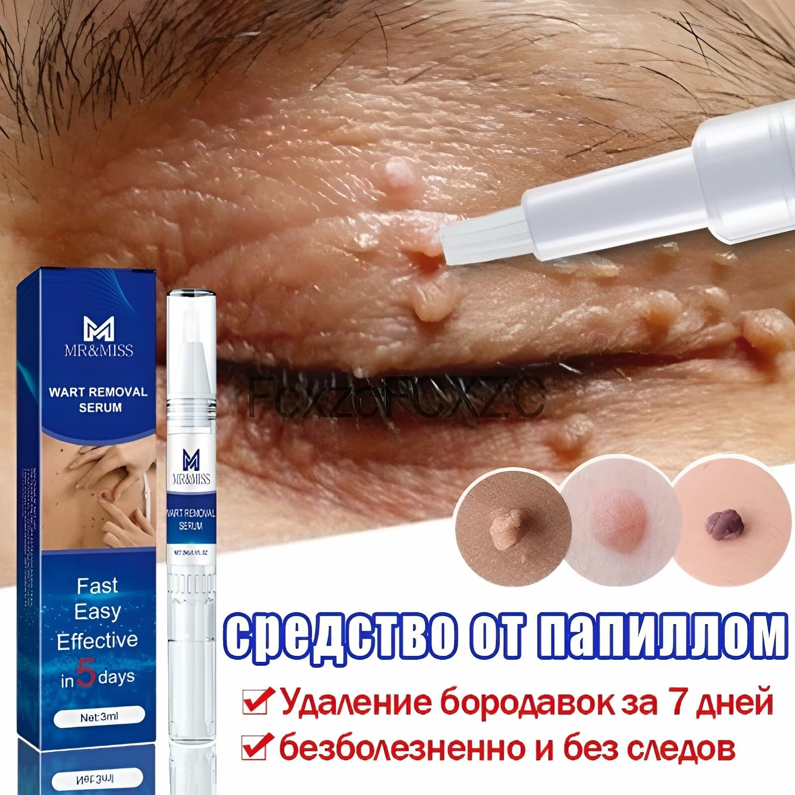 Эссенция для удаления бородавок, папиллом и родинок, безболезненно, без шрамов и побочных эффектов / 3 мл, Быстрое удаление бородавок Нежный от бородавок средство