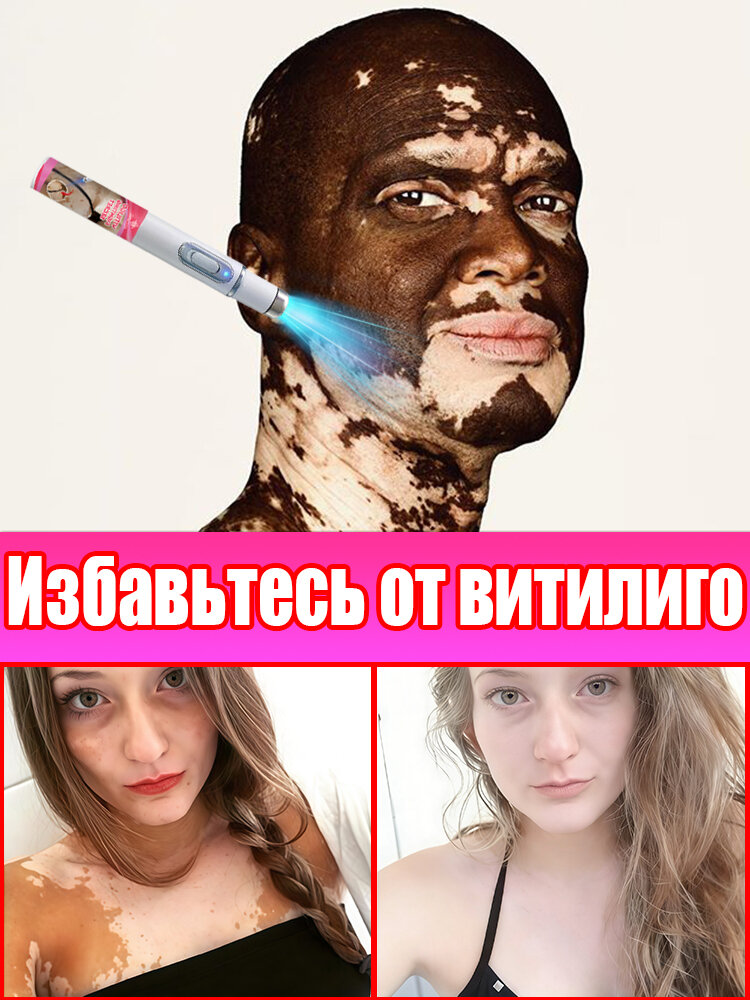 Лазерная указка для устранения витилиго. Эффективно удаляет белые пятна, быстро лечит витилиго, безболезненно и без побочных эффектов