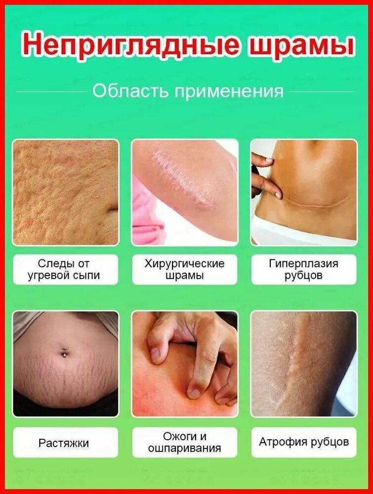Крем для удаления шрамов. Быстро удаляет шрамы, растяжки, ожоги, следы от прыщей, отеки после ран и пигментацию. Подходит любой части тела. 30 мл
