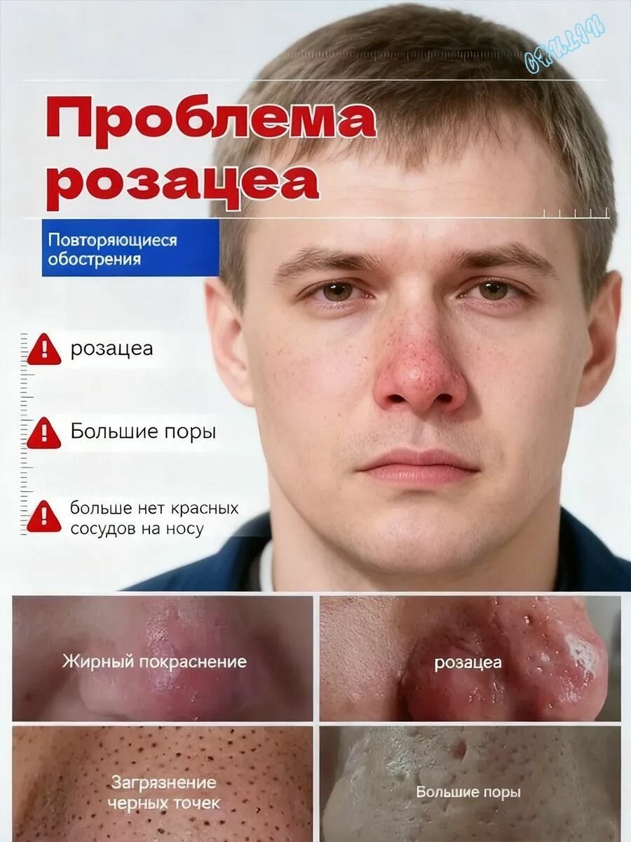 Крем от купероза для лица для чувствительной 30 г