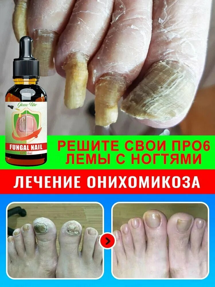 При грибке ногтей на ногах, эфирное масло при онихомикозе, для лечения ногтей, профилактика грибковых инфекций 50 мл