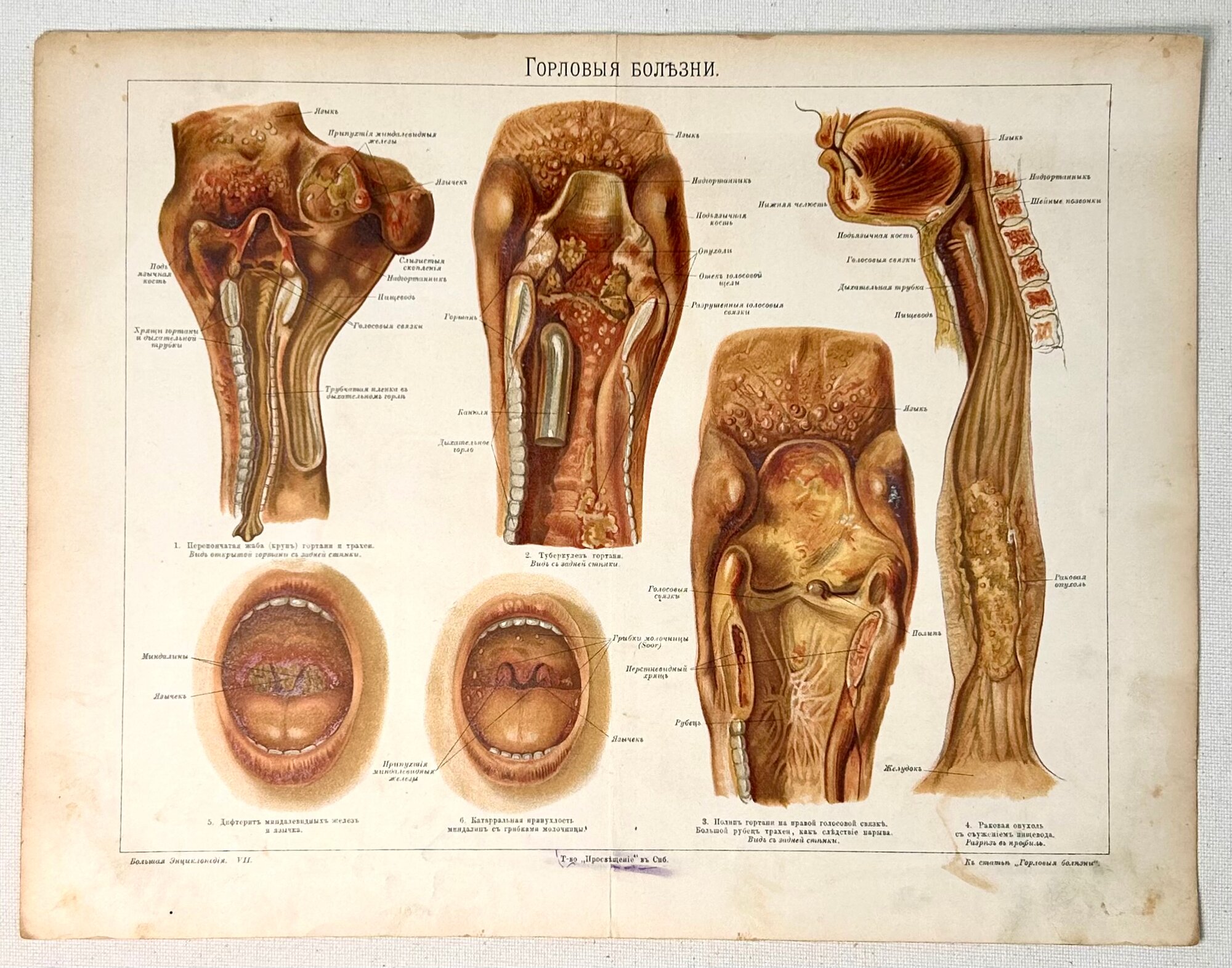 Антикварная анатомическая литография “Горловые болезни”, начало XX века, 24×31 см
