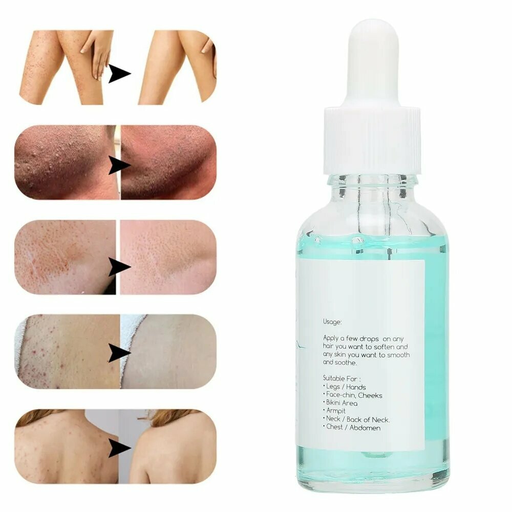 Lanthome Сыворотка от вросших волос уменьшает ожоги от бритвы, уход за кожей темных пятен для мужчин и женщин, 30 мл