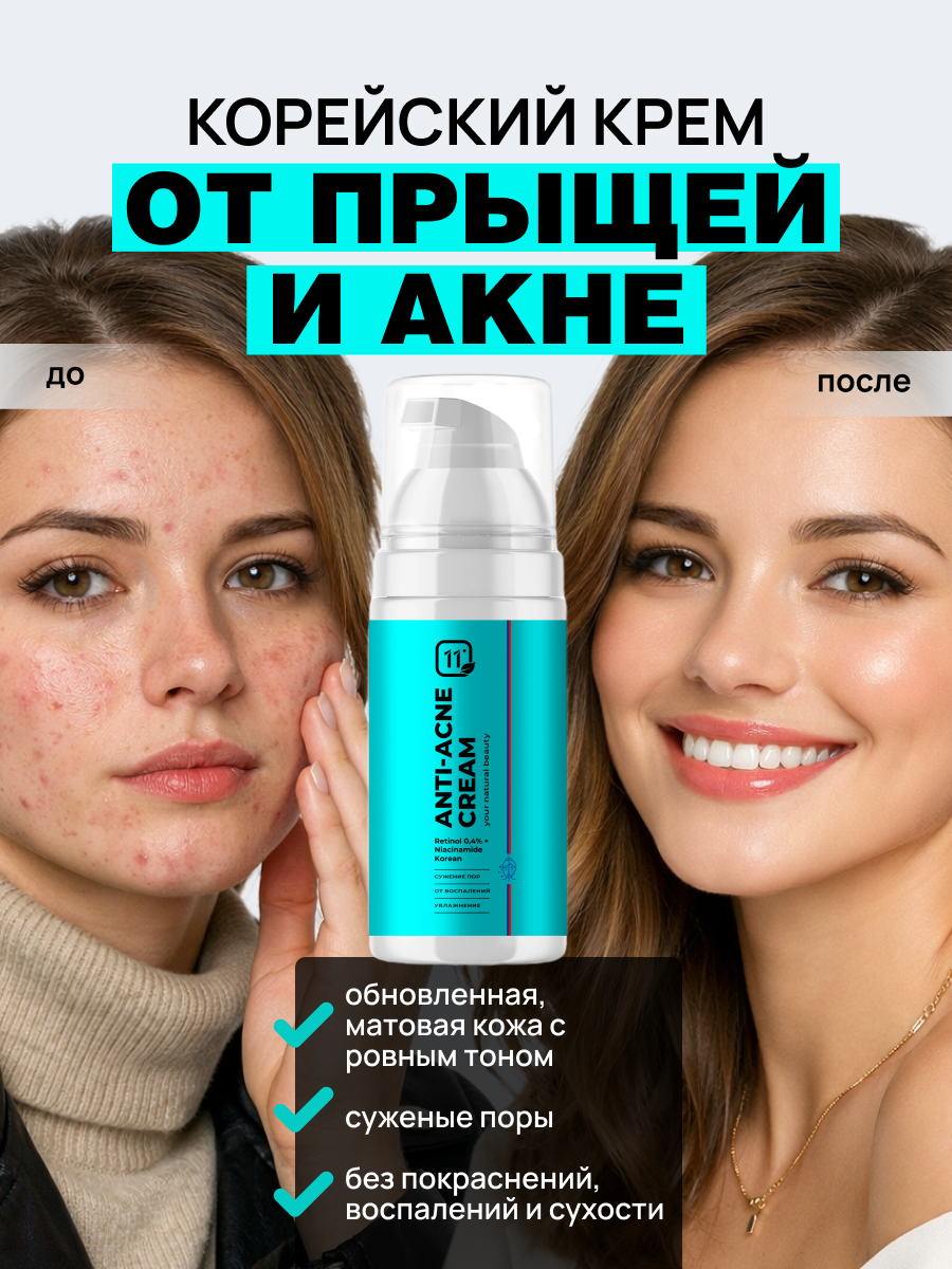 Крем от прыщей и акне для лица с ретинолом и ниацинамидом, Корея