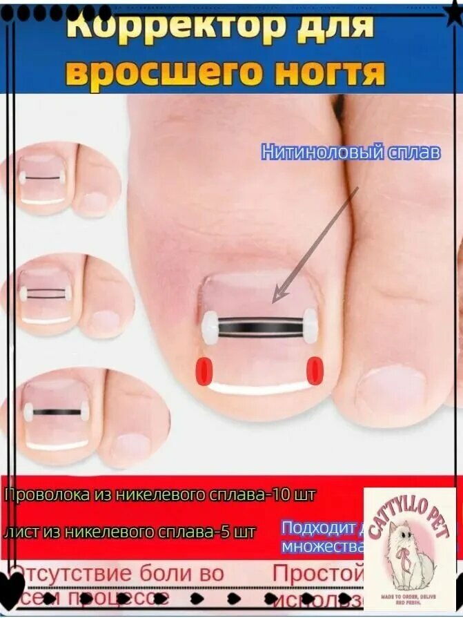 Комплект из 10+5 никелид-титановых корректоров для вросших ногтей