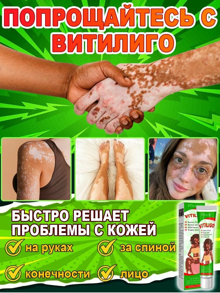 Мазь для лечения витилиго, эффективно удаляет белые пятна и регулирует пигментацию, выравнивает тон кожи и устраняет странные взгляды окружающих, 20 грамм