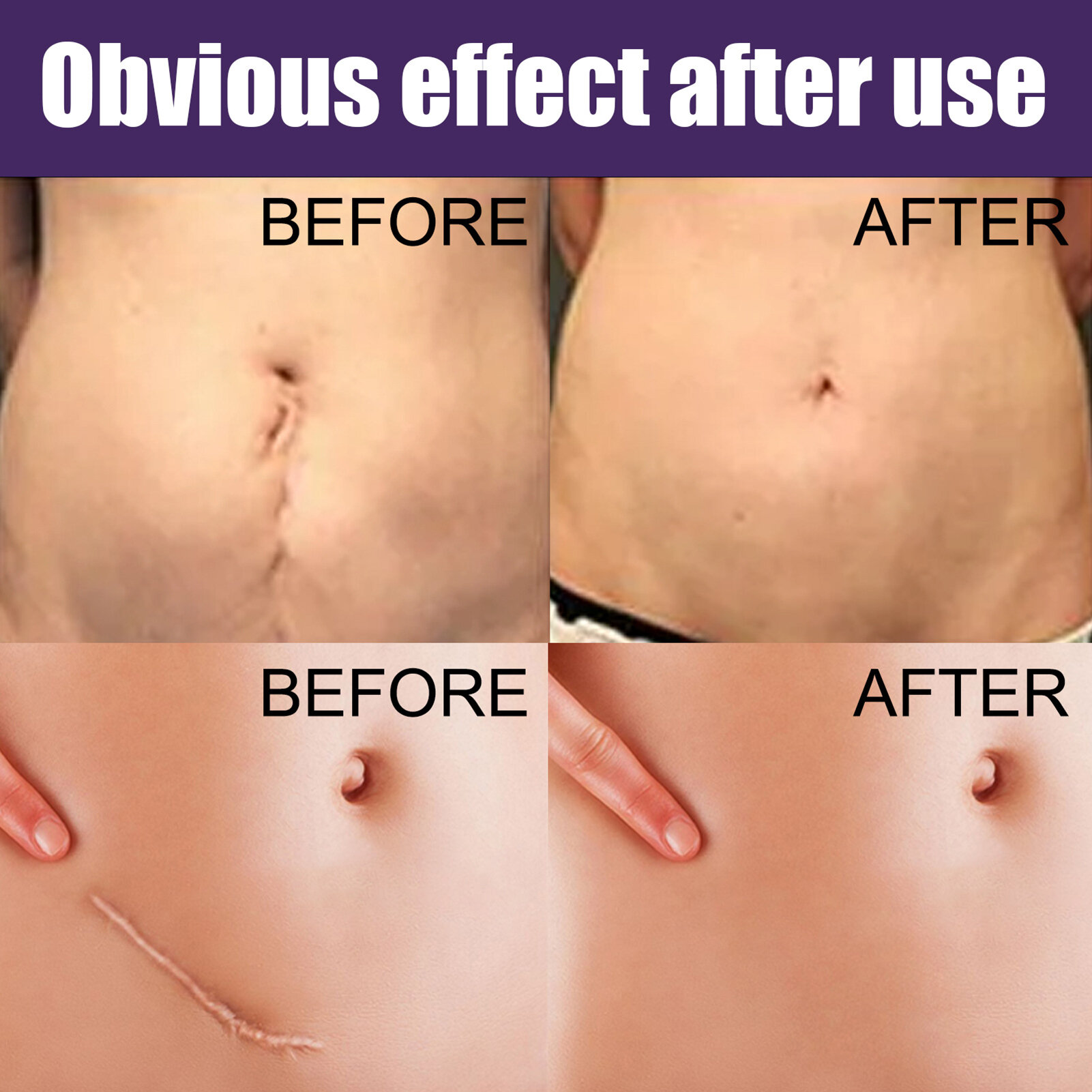 EELHOE 8 шт. силиконовые пластыри от шрамов безопасные мягкие без запаха удобные исчезающие шрамы заживление лечение старых новых шрамов