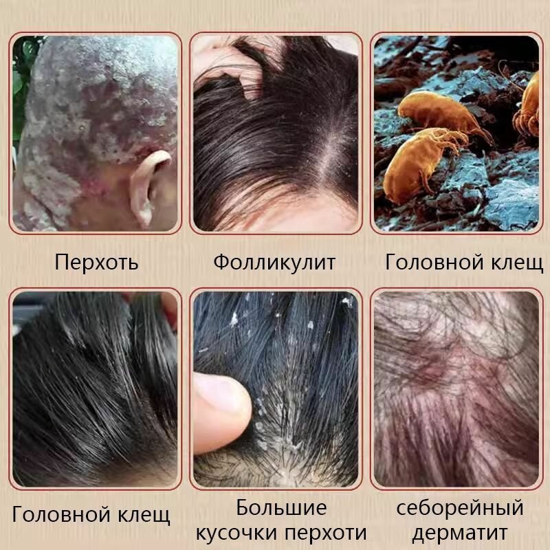 Крем от стригущего лишая кожи головы 20 г против дерматита фолликулита грибковых инфекций псориаза и других заболеваний кожи головы