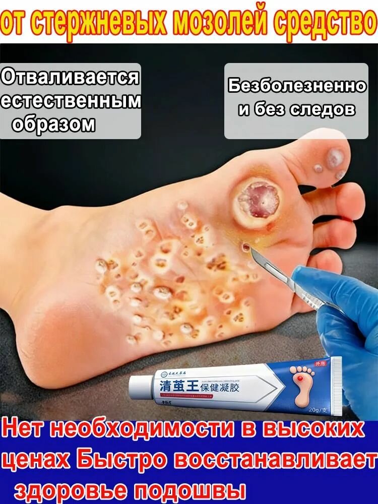 Мазь для удаления сухих мозолей, снятия огрубевшей кожи, лечения коконов и натоптышей на подошвах ног, 20 г