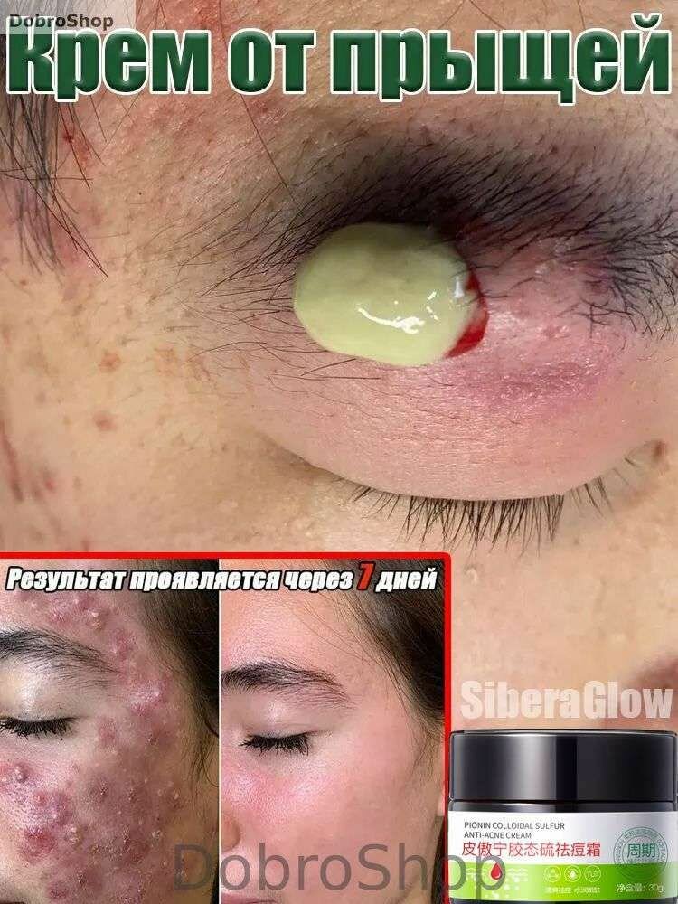 Крем от прыщей, направленная на акне и угри, эффективно борется с воспалениями, подходит подросткам и проблемной коже, 30 г.
