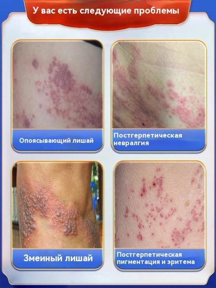 Мазь от опоясывающего лишая, 50 г Быстро снимает зуд и боль Для лечения постгерпетической невралгии и "змеиного лишая" Наружное применение