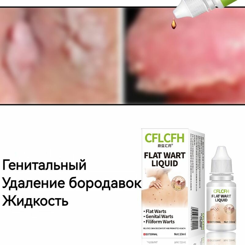 Капли для удаления бородавок, Травяной экстракт, использовать для убирать папилломы, Остроконечные кондиломы,10 мл, Облегчение проблем с кожей