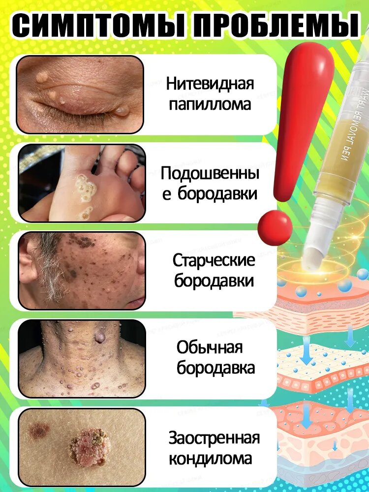 Гель от папиллом и бородавок на основе чистотела, средство для удаления наростов на коже дома, от кондилом, точечное нанесение, Без шрамов после удаления папиллом, Быстрое действие от бородавок, 5 мл