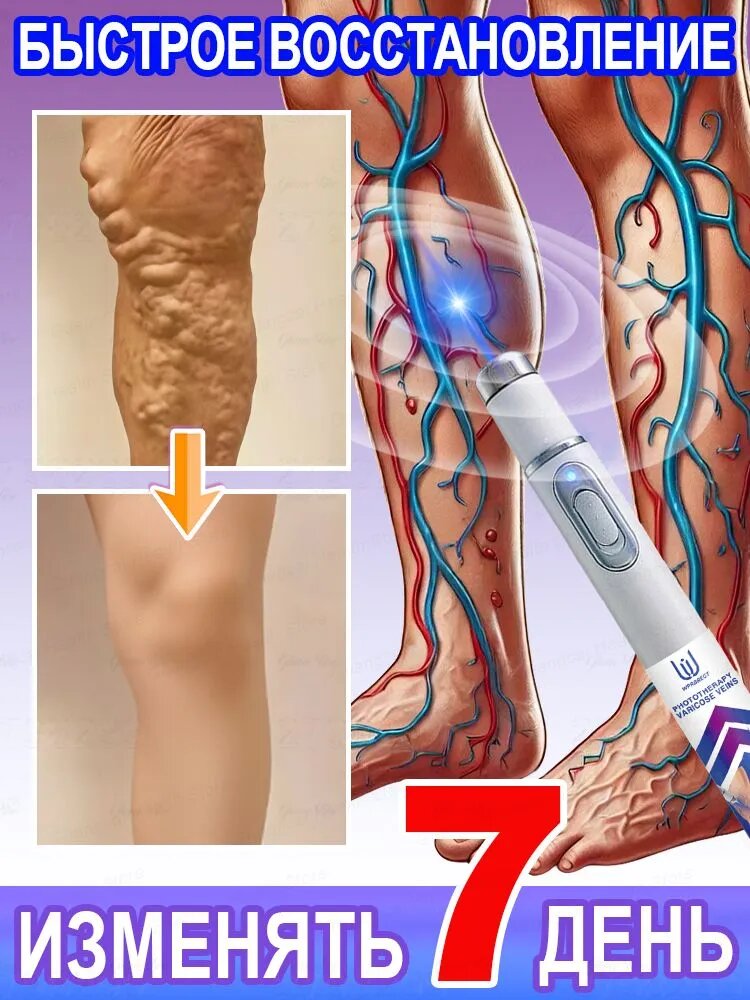 Лазерное лечение варикозного расширения вен. эффективное и быстрое удаление, безболезненное, без шрамов, без побочных эффектов