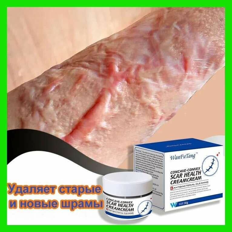 Крем от шрамов и рубцов, от постакне, крем от растяжек, Натуральный без побочных эффектов, Удаляет старые и новые шрамы / 30г