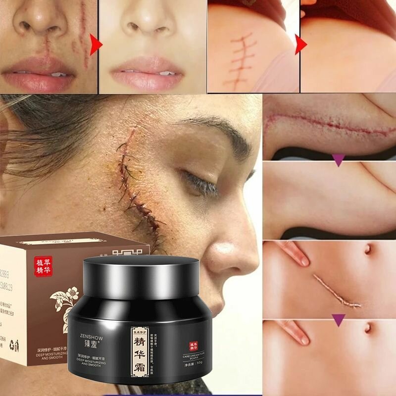 Средство от растяжек