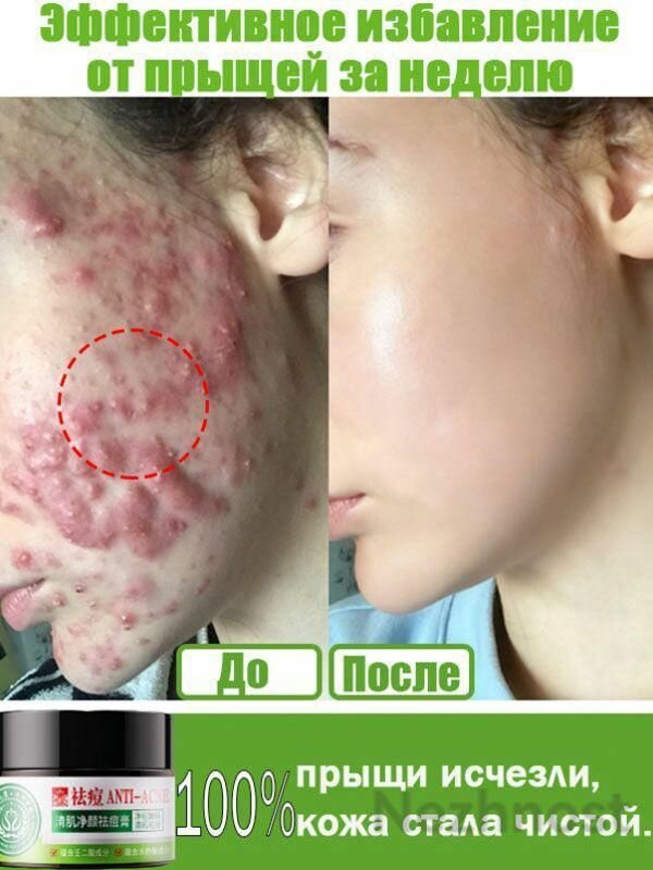 Салициловая мазь от прыщей, направленная на акне и угри, эффективно борется с воспалениями, прыщами и последствиями акне, подходит подросткам и проблемной коже, 30 г.