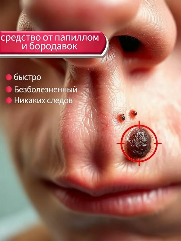 Удаляет плоские, обыкновенные и подошвенные бородавки на лице, теле, руках и шее. чистотелом от папиллом и бородавки. крем против кондилом.20 г
