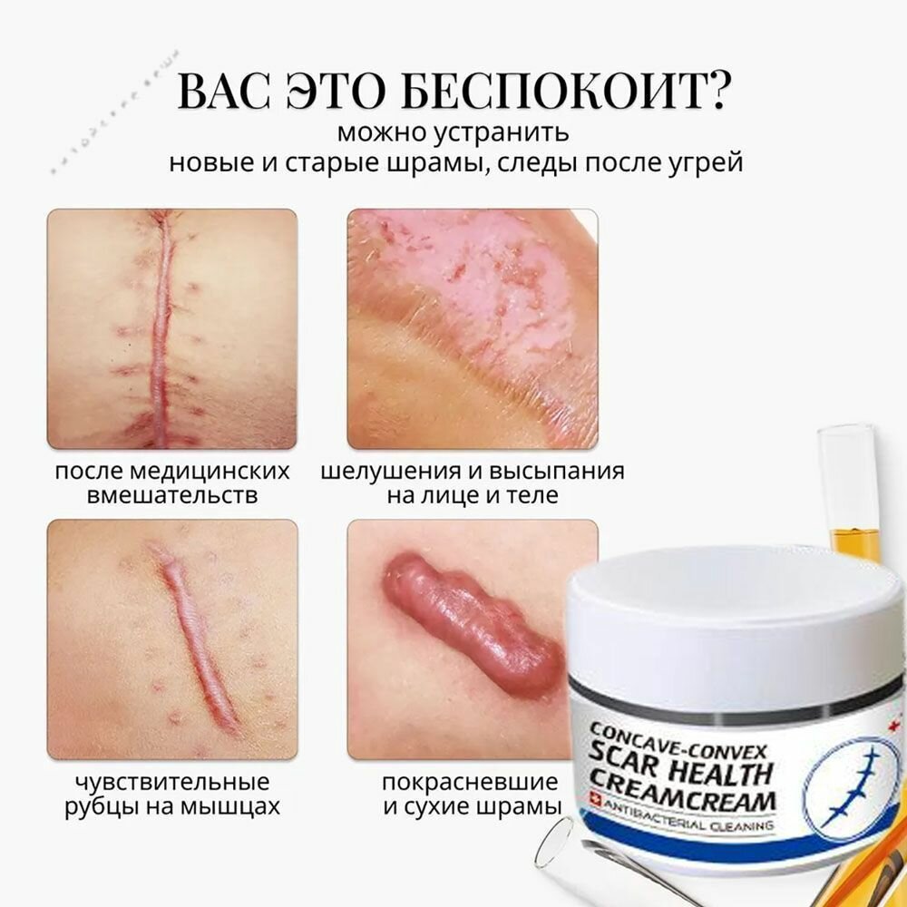 Крем-гель от шрамов, рубцов, растяжек, травм и пигментации, мазь от следов прыщей для лица и тела