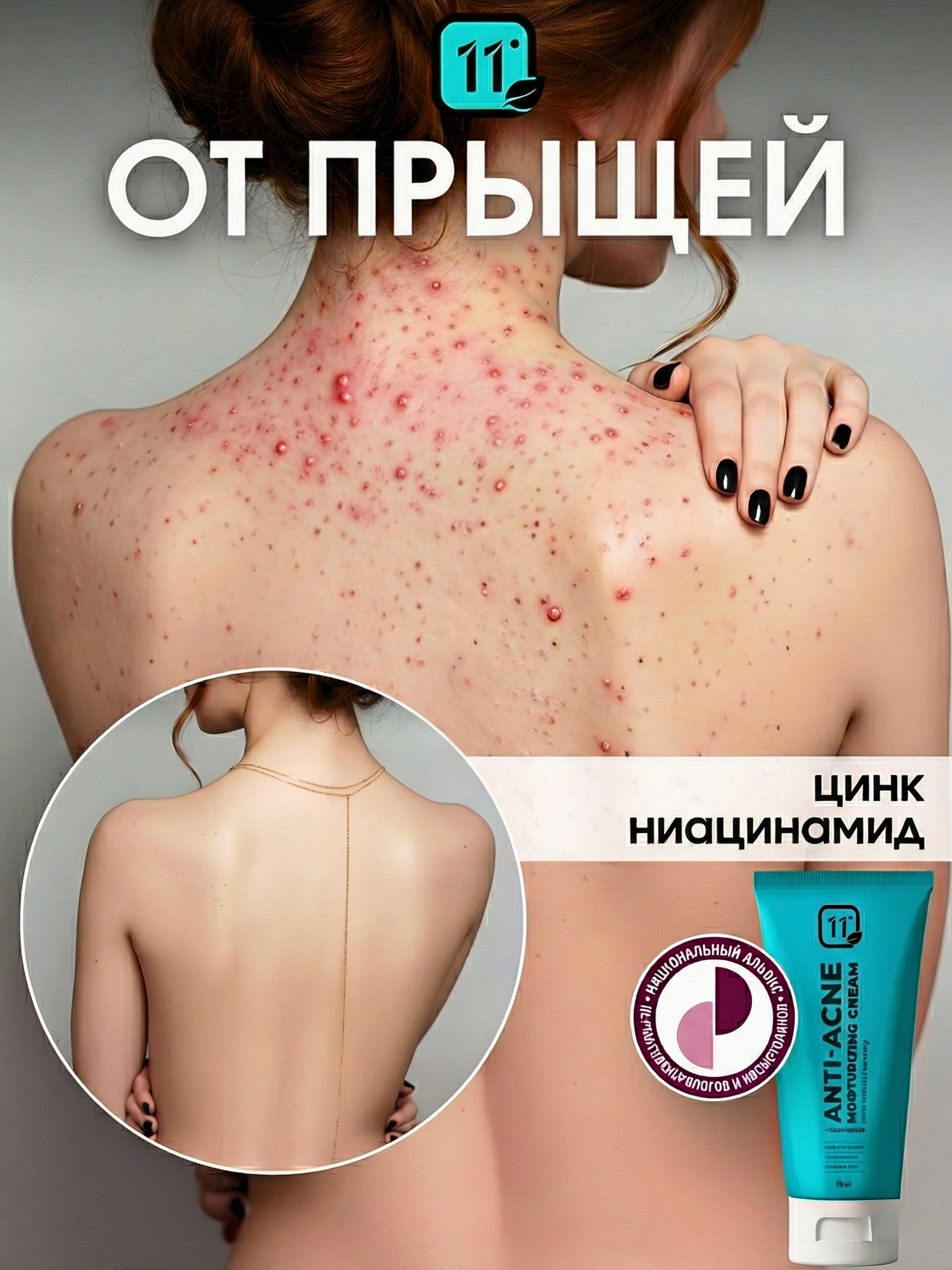 Крем от прыщей, акне и черных точек для лица и тела с ниацинамидом 3%, 40 мл