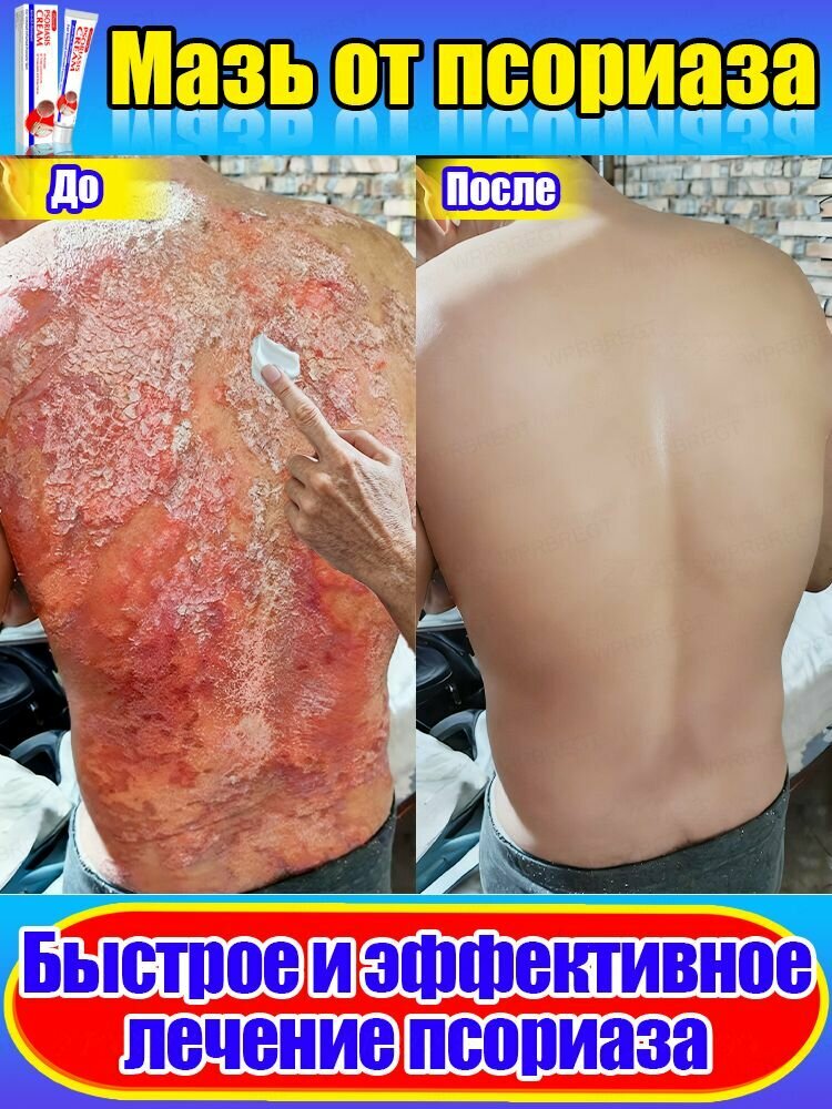 Мазь от псориаза, быстро снимает зуд, снимает покраснение, лечит псориаз, дерматит, экзему, грибковые инфекции, потницу и герпес, длительное увлажнение, нежное и не раздражающее действие