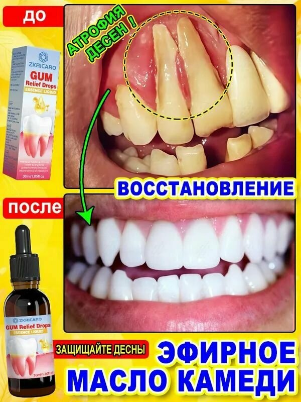 Эфирное масло для ухода за полостью рта на растительной основе, антибактериальное, защищает десны, снимает воспаление, подходит для людей с атрофией десен и чувствительными зубами.30 мл на флакон