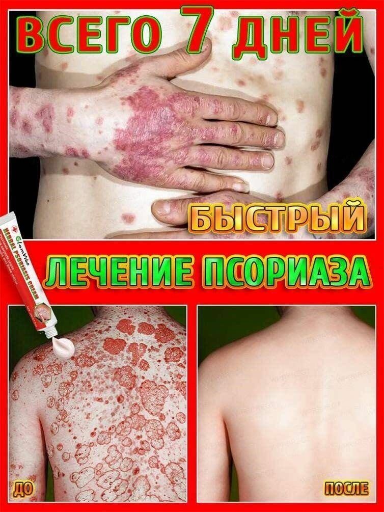 Мазь для лечения псориаза, экземы, дерматита, лишая, угревой сыпи, прыщей, способна быстро снять раздражение и покраснение кожи,20г