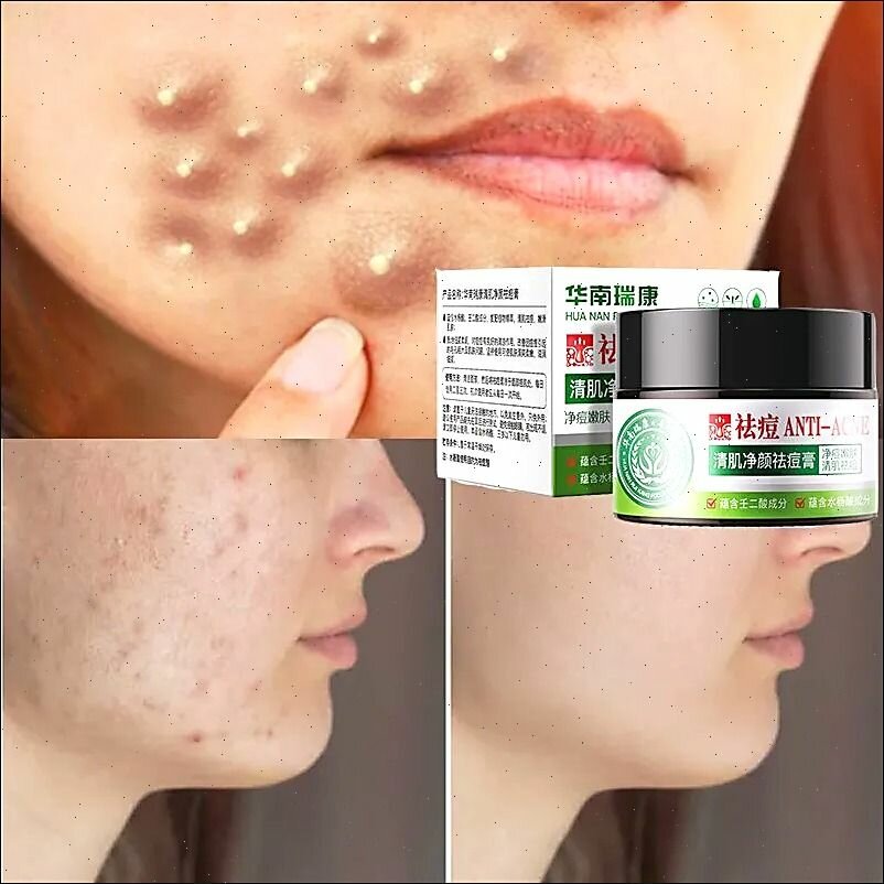 Очищающий крем от прыщей и акне, 30 г быстрое устранение воспалений, восстанавливает кожный барьер, осветляет следы от прыщей