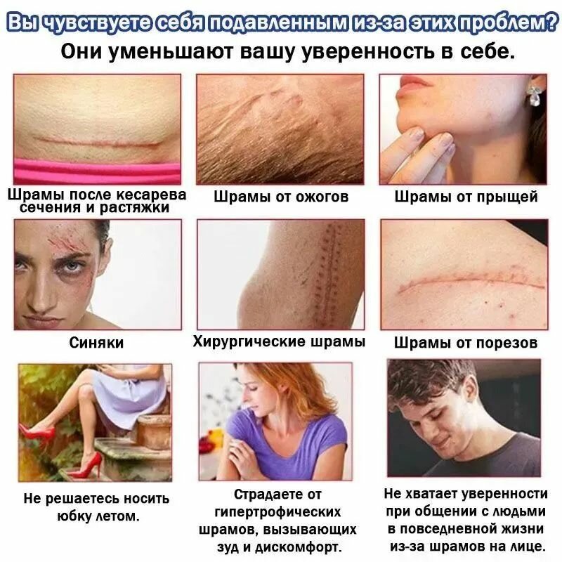 Заживляющая антибактериальная мазь от шрамов, 30 грамм, уменьшает рубцы и восстанавливает кожу, предотвращая регенерацию рубцовых бактерий.
