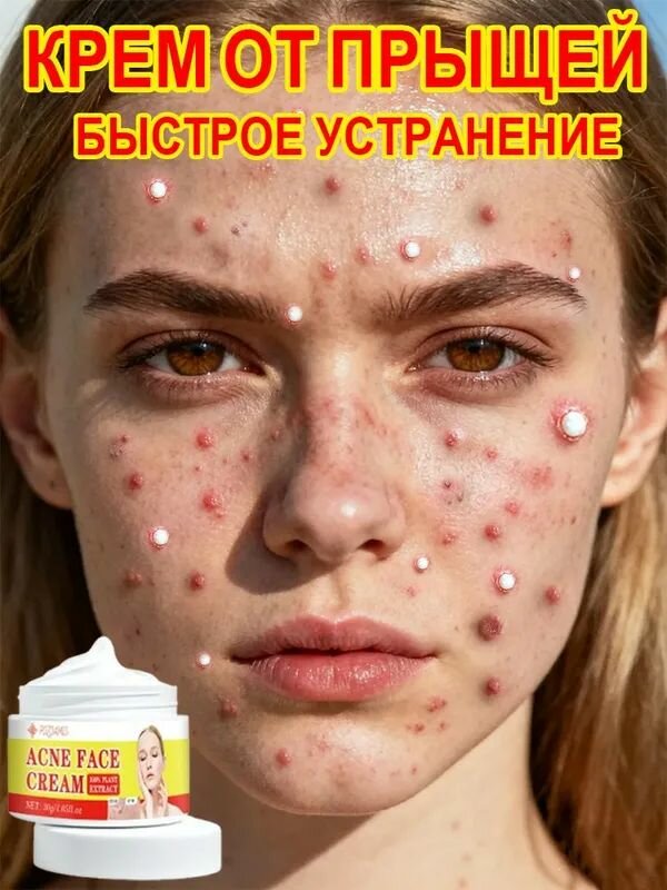 Крем от прыщей / От акне и постакне, для проблемной кожи лица, от шелушения, от покраснений, от псориаза, acnelyse от угрей / 30 мл
