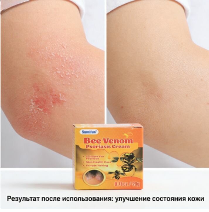 Bee Venom Psoriasis Cream (Крем с Пчелиным Ядом от Псориаза) 1-12-zmy-42
