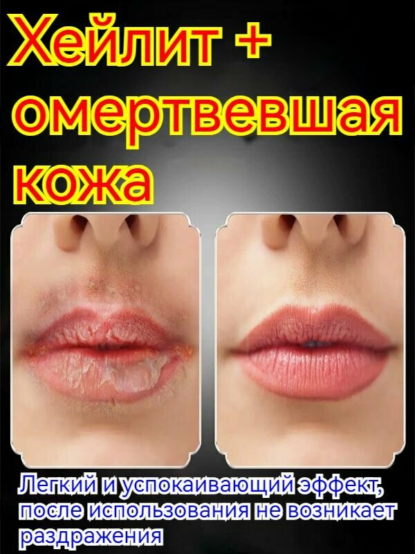 Крем от герпеса и хейлита Sumifun, против трещин и сухости на губах