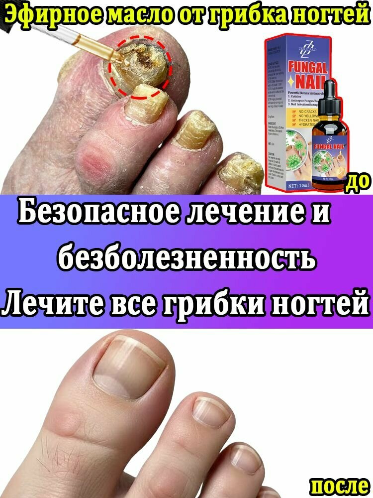 Эфирные масла, используемые для лечения онихомикоза. Быстро устраняют микоз ногтей, используют противогрибковые препараты, устраняют паратиреоидит, восстанавливают ногти и улучшают их здоровье.10 мл