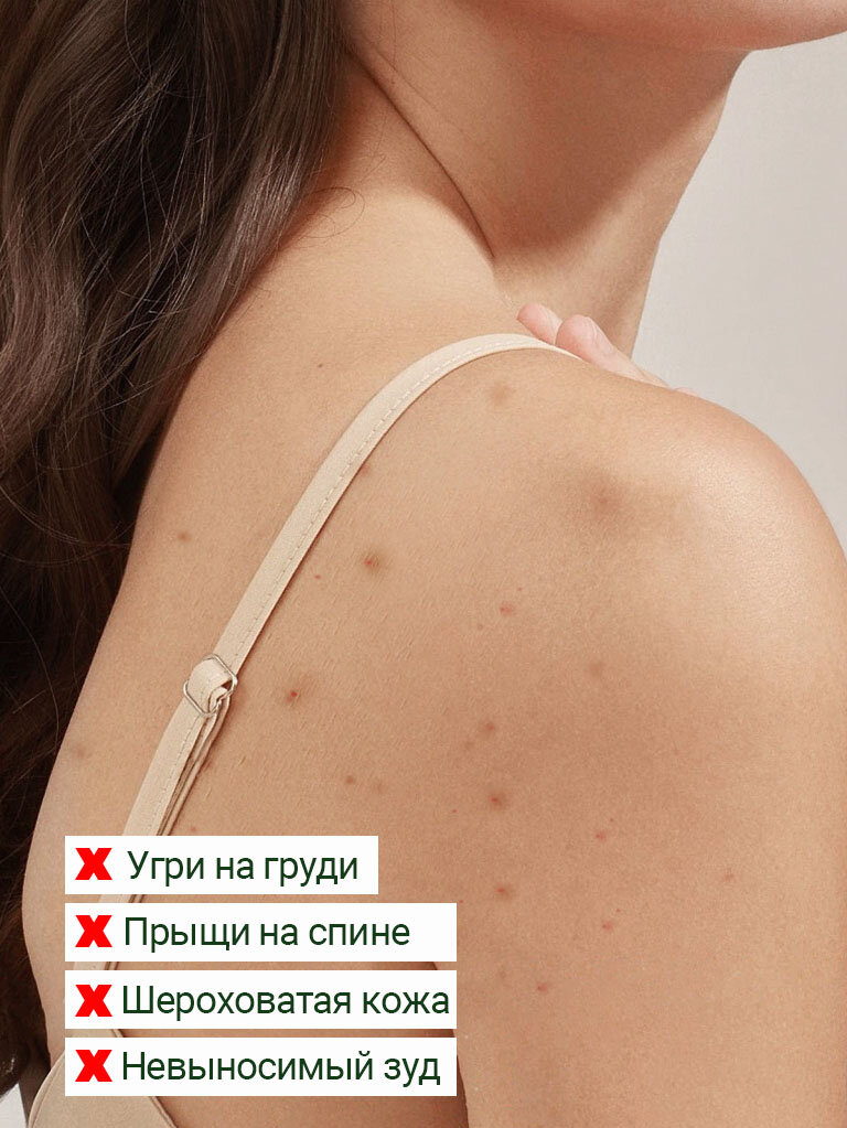 Спрей для тела и лица от прыщей на спине и лице увлажняющий а также крем и средства от угрей 150мл