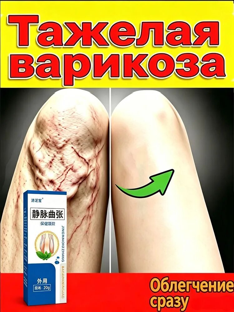 Гель от варикоза, успокаивающий и снимающий отек ног
