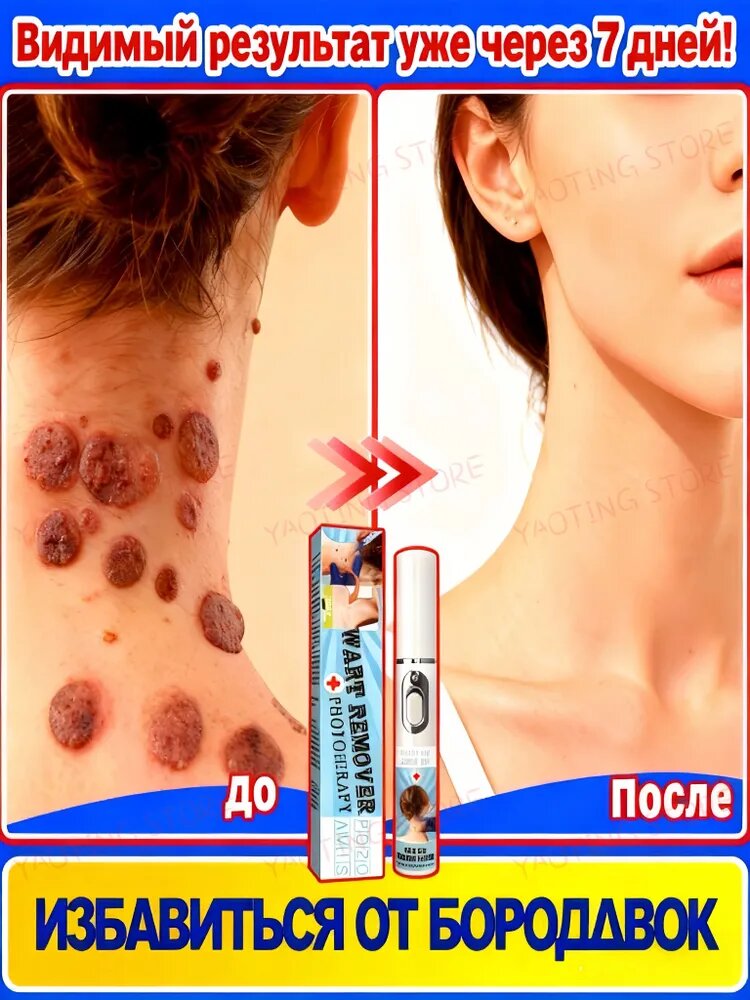 Лазерный аппарат для удаления бородавок позволяет удалять бородавки и папилломы без образования рубцов. Он точен и эффективен, в каждой упаковке содержится один такой аппарат.