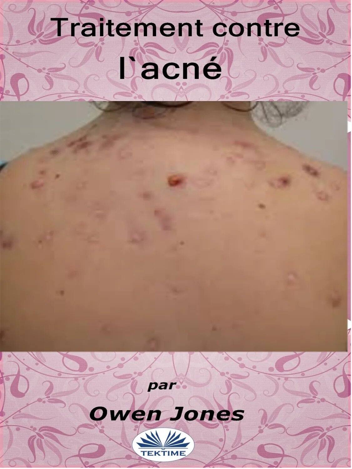 Traitement Contre L'Acné [Цифровая книга]