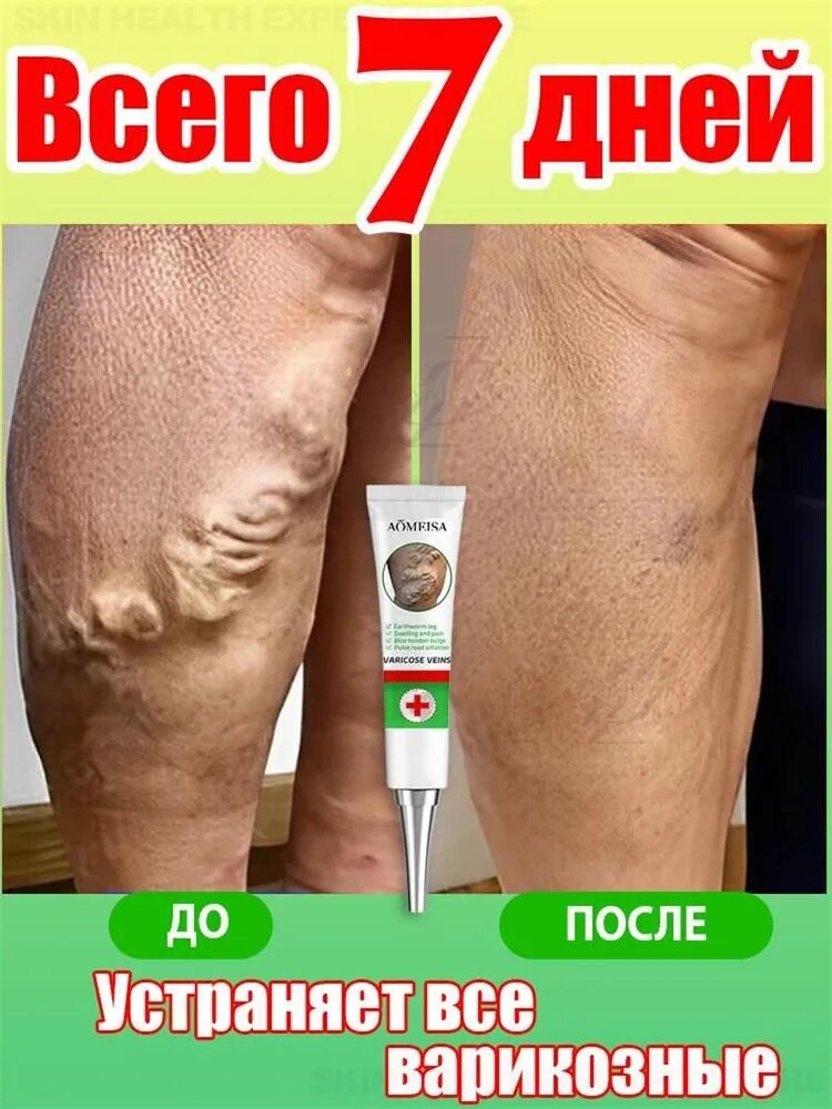 Крем от варикозного расширения вен, эффективное лечение варикозного расширения вен, сосудистых звездочек, тромбоза, усталости, отёков и боли в ногах,200 г