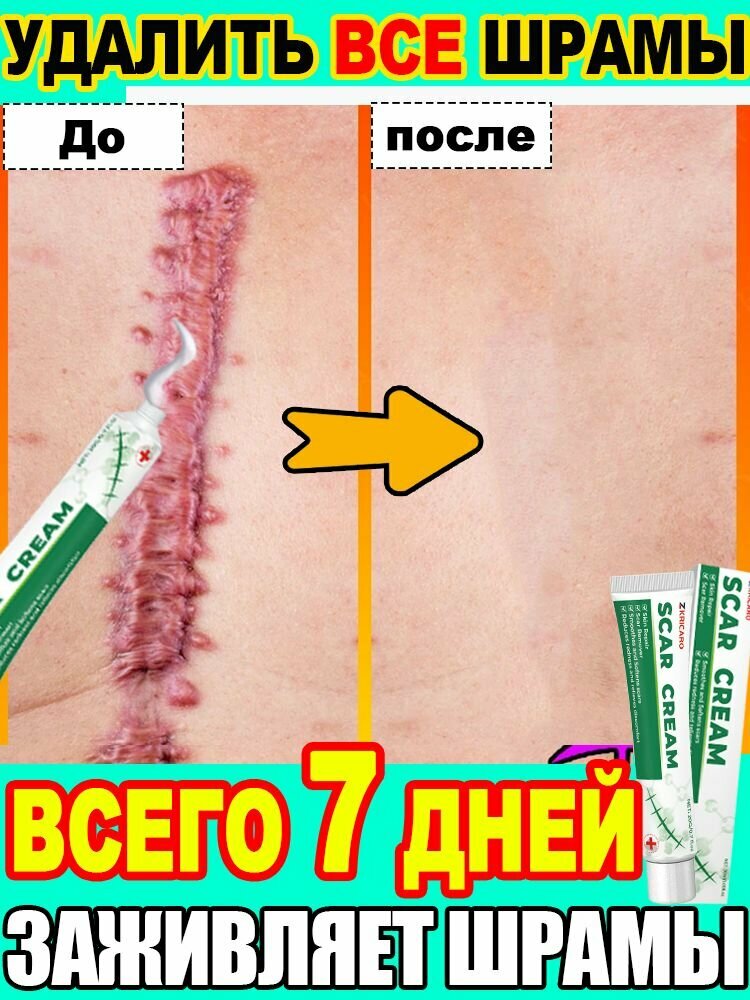 Крем для восстановления рубцов. Средство для быстрого осветления гипертрофических, послеоперационных и послеродовых ожоговых рубцов; бережное и подходит для чувствительной кожи.1 коробка по 20