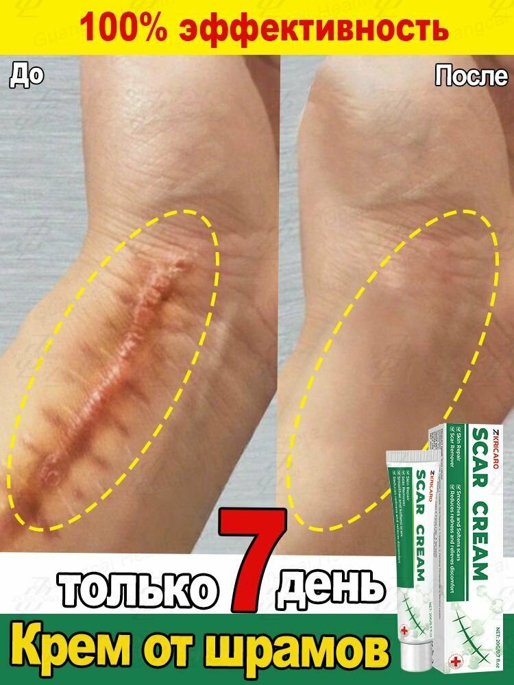 Крем от рубцов смягчает рубцовую ткань, уменьшает пигментацию и способствует восстановлению и регенерации кожи