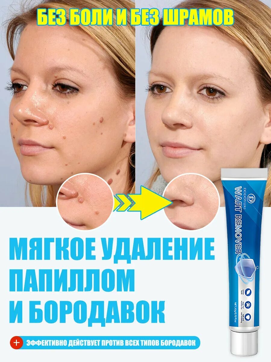 Мягкая мазь от бородавок — Без боли и без рубцов, для детей и взрослых, с натуральными экстрактами, 20 г
